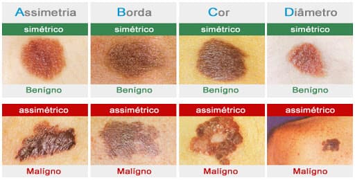Dermatoscopia Digital e Mapeamento Corporal em Campinas